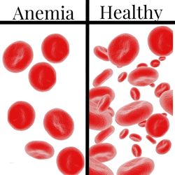 Anemia